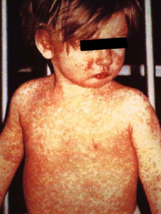 Disneyland measles outbreak continues to spread | 13wmaz.com
