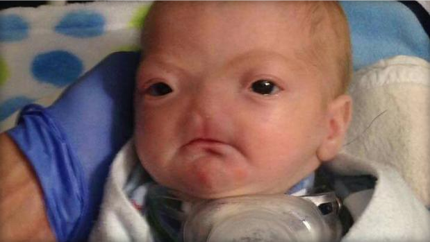 Mom seeks help for baby born without a nose | 13wmaz.com